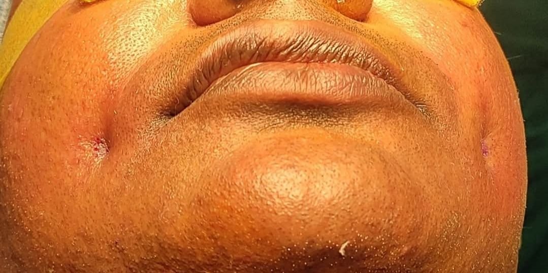 Dimple creation/ Dimpleplasty – Dr Nema Hair, Laser & Cosmetic Surgery ...